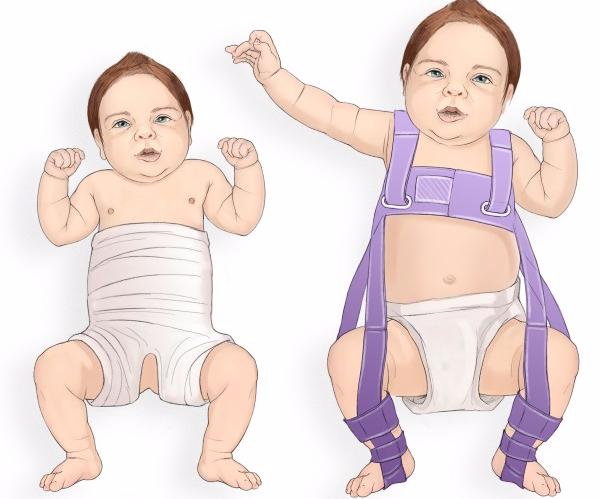 Дисплазия тазобедренных суставов у детей, симптомы, лечение дисплазии ...